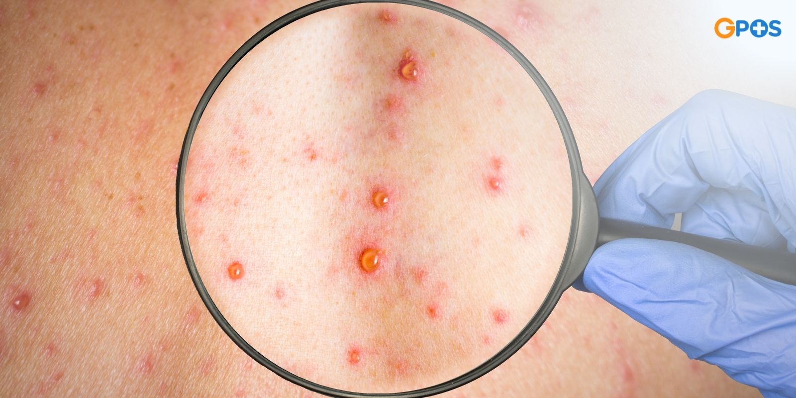 Fakta Cacar Air yang harus Apoteker Tahu - GPOS.ID